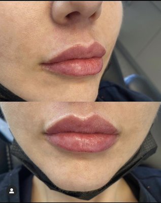 BOTOX SISTERS- LAURA HERTZOG, NP & REBECCA CEVERHA, NP - Updated ...