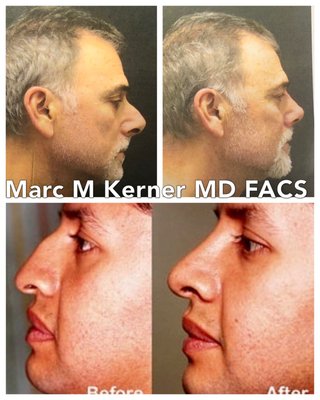 MARC M KERNER, MD, FACS - Updated March 2026 - 59 Photos & 94 Reviews ...