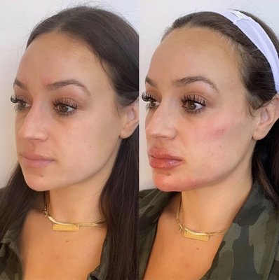 BOTOX SISTERS- LAURA HERTZOG, NP & REBECCA CEVERHA, NP - Updated ...