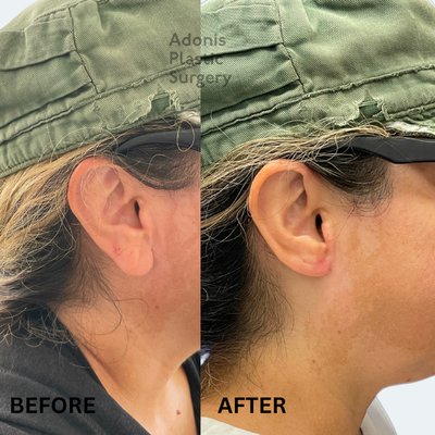 ADONIS PLASTIC SURGERY - Updated October 2025 - 59 Photos - 29 Reviews - 2557 Pacific Coast Hwy ...